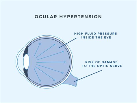 Intraocular Pressure Normal Glaucoma Fact Sheet Vista Center For