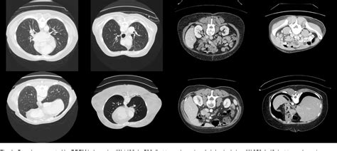 Label Efficient Multi Organ Segmentation Method With Diffusion Model