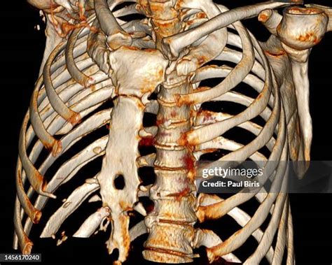 Foramen Photos And Premium High Res Pictures Getty Images