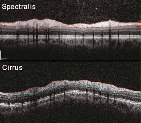 Top Spectralis Rnfl Circular Cut Of An Oct With Image Quality Of 26 Download Scientific