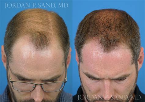 Prp To Scalp 2 Sand Plastic Surgery Of Spokane