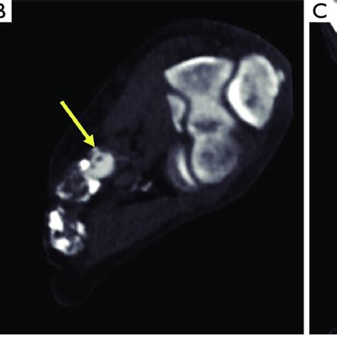 Emboli Ct Angiogram In A Patient With Chronically Occluded