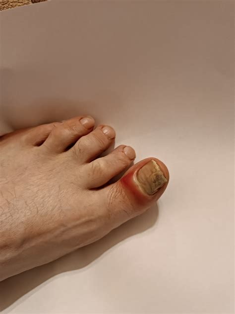 Воспалился большой палец на ноге у ногтя Палец и ноготь на протяжении Medaboutme