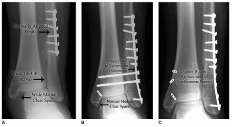 Tibiofibular Syndesmosis Reduction And Fixation Musculoskeletal Key