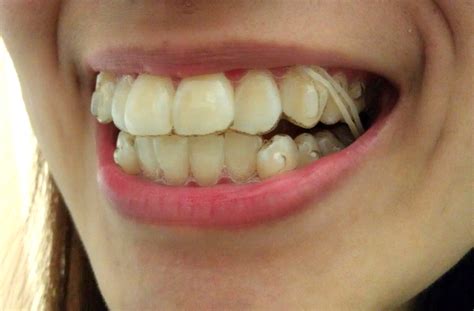 To A Better Smile Invisalign Stretchy Elastics And Aligner 3