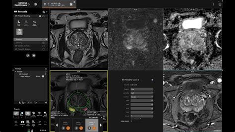 Mr Prostate Ai Based Segmentation And Classification
