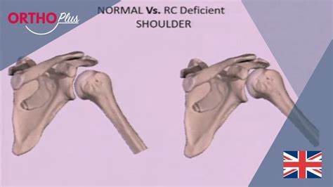Presentazione Can Reverse Shoulder Arthroplasty Solve Any Problem