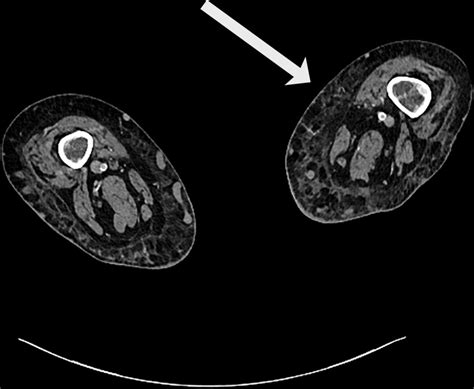 Calciphylaxis In The Absence Of Pathological Skin Lesions Bmj Case Reports