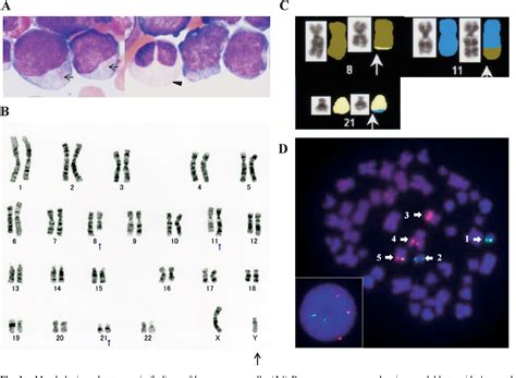figure 1 from a new complex translocation t 8 11 21 q 22 q 24 q 22 in acute