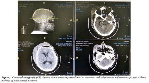 Preseptal Cellulitis And Lid Abscess Secondary To Necrotizing Fasciitis Of Scalp Case Report