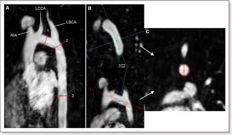Figure 1 From Persistent Aortic Arch Hypoplasia After Coarctation