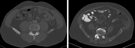 Variation In Morphometric Characteristics Seen On Pre Operative Ct Scan
