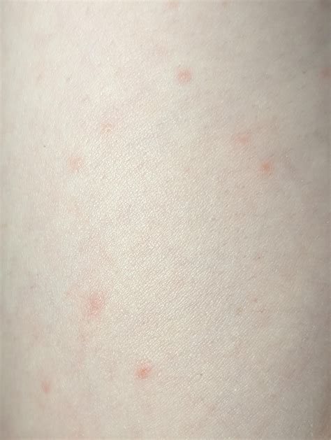 Rash From Strep But Not A Strep Rash Rurticaria