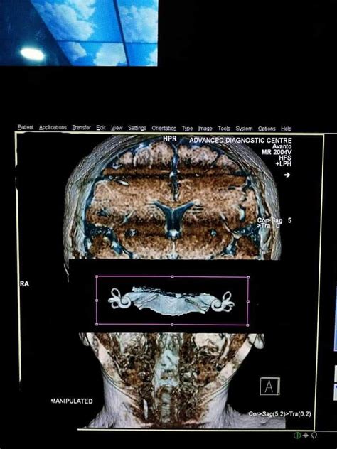 Mri For Cochlea With 3d Ciss On Rohullah Hasnain