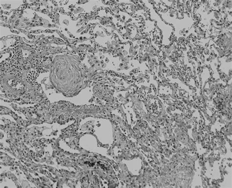 Pathologic Findings Of Subacute Hypersensitivity Pneumonitis Download Scientific Diagram