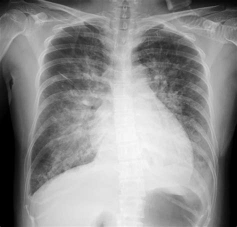 Initial Chest Xray Revealed Interstitial Pulmonary Edema