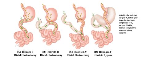 Kindkes Scrap Notes Duodenal Bypass Resolves Type 2 Diabetes Without