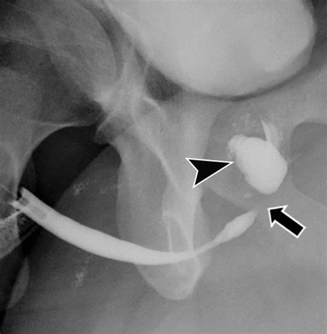 Imaging Of The Bulbourethral Cowper Gland Abnormalities And