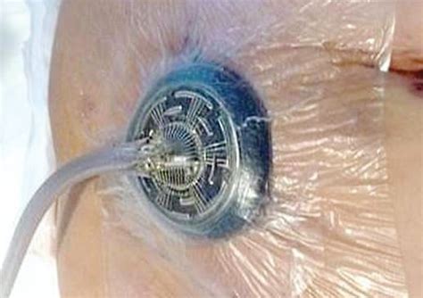 Ileostomy Reversal Scar