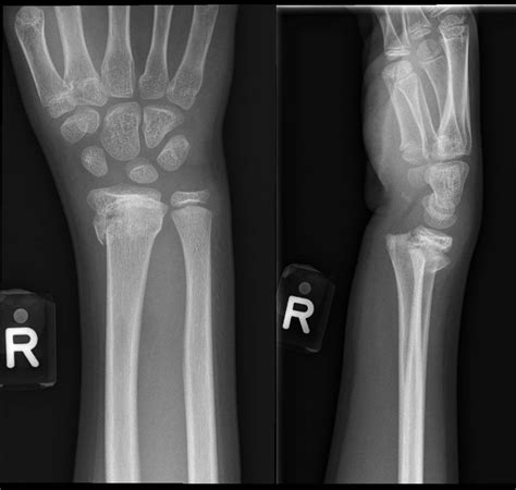 Salter Ii Fracture Radius