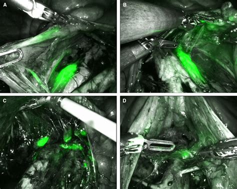 Robotic Staging Of Cervical Cancer With Simultaneous Detection Of Primary Pelvic And Secondary