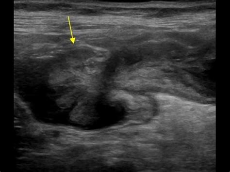 Abdomen And Retroperitoneum 15 Appendix Case 154 Unusual Causes