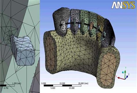 Anterior Teeth Splinting After Orthodontic Treatment 3d Analysis Using Finite Element Method Pmc