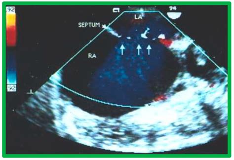 Role Of Echocardiography In The Diagnosis And Interventional Management