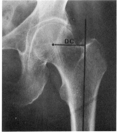 Figure 4 From Radiographic Measurements Of The Femoral Neck Anteversion Comparison Of Two