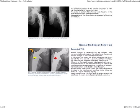 The Radiology Assistant Hip Arthroplasty Pdf