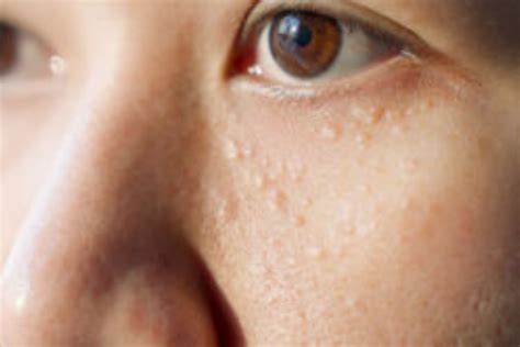 Hyperplasie Sébacée Clinique Infinium Gatineau Ottawa