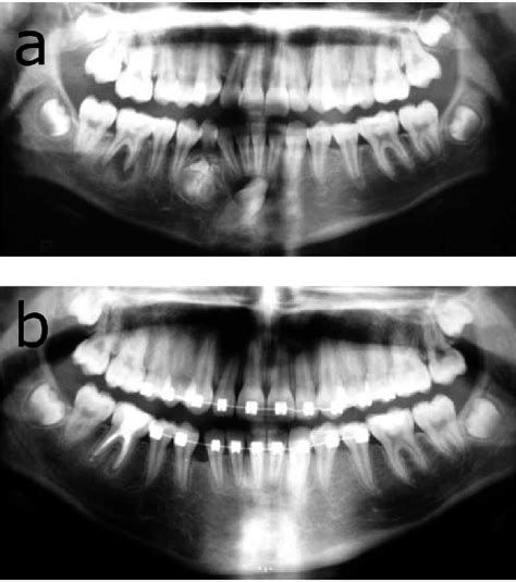 Odontoma Treatment