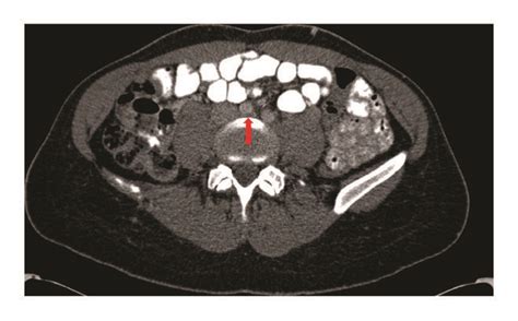 Ct Venogram Of The Abdomen Pelvis Revealed A Compression Of The Left