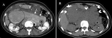 Large Ivc Aneurysm A Dash Circle Associated With Dilated Left Renal