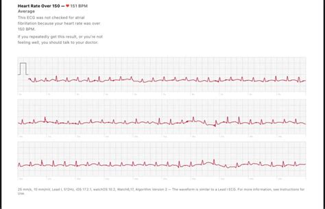 Sinus Tach R Readmyecg