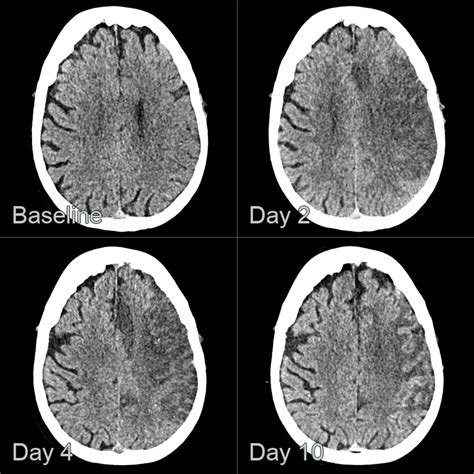 Cortical Laminar Necrosis Neuroradiology