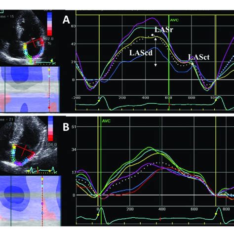 Analysis Of Left Atrial Strain In Controls A And Hypertrophic