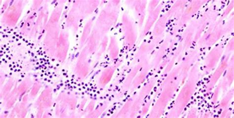 Necrosis Coagulationis Zdravlje