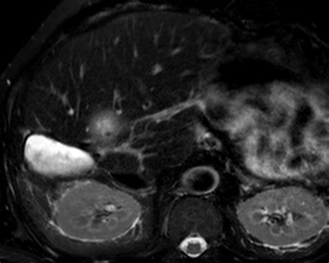 Liver Atlas Diagnosis Metastasis Cholangiocarcinoma
