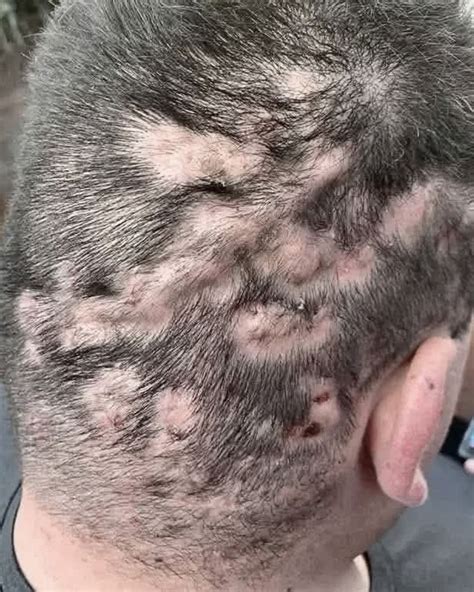 Dissecting Cellulitis Of The Scalp Symptoms Causes And Treatment