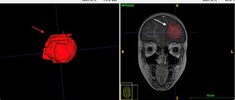 semi automatic segmentation and 3d tumor rendering with itk snap in a