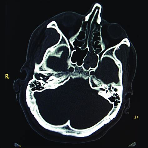 Axial Ct Shows The Longitudinal Fracture Of The Right Temporal Bone And