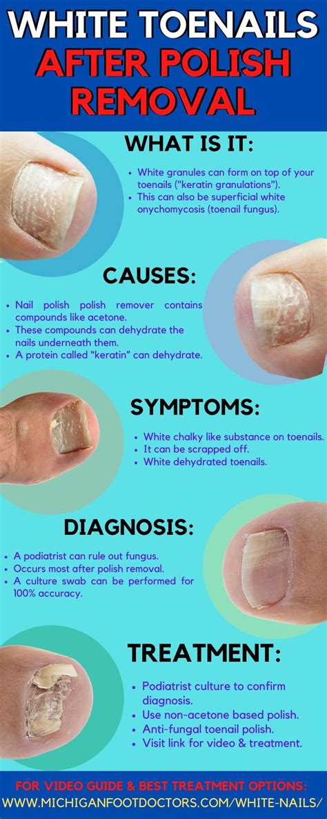 White Chalky Toenails 7 Causes And Effective Treatments