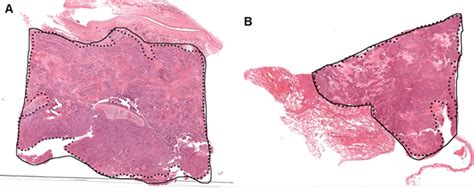 Automated Tumor Analysis For Molecular Profiling In Lung Cancer Oncotarget Automated Tumor Analysis For Molecular Profiling In Lung Cancer Oncotarget