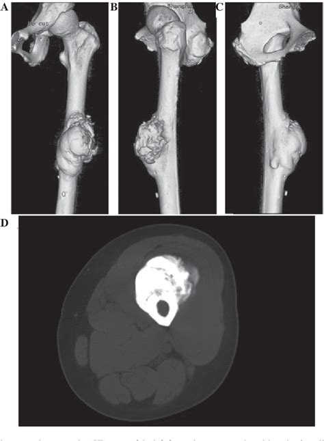 Figure 1 From Custom Made Intercalary Endoprosthetic Reconstruction For