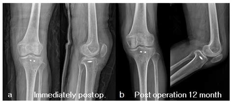 Tibial Tuberosity Fracture Apophysiolysis Of The Tibial Tuberosity In