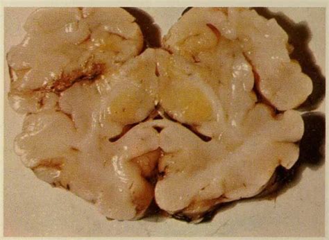 What Is Kernicterus Klarity Health Library