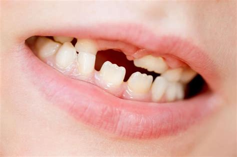¿qué Son Los Mamelones Dentales Odontocenter