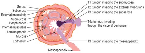 The Vermiform Appendix And Its Pathologies