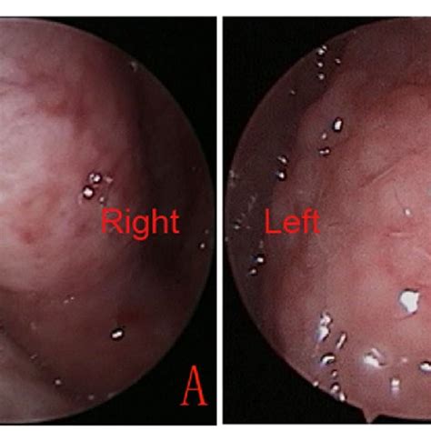 Endoscopic Examination Showed Hyperplastic Mucosa And A Narrow Tubal